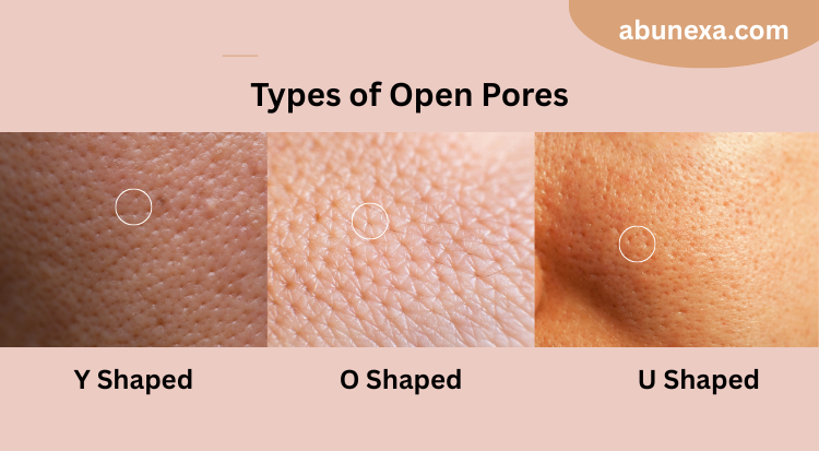 Open Pores: Causes, Types, and Effective Treatments - abunexa.com